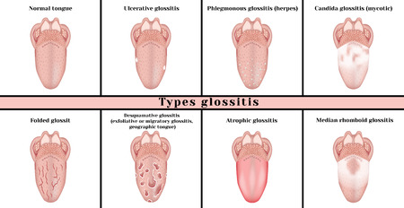 Vector of Types glossitis: candidiasis - ID:60623983 - Royalty Free ...