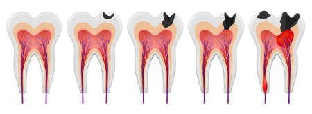 Photo of Stages of caries development - ID:1-186572526 - Royalty Free ...