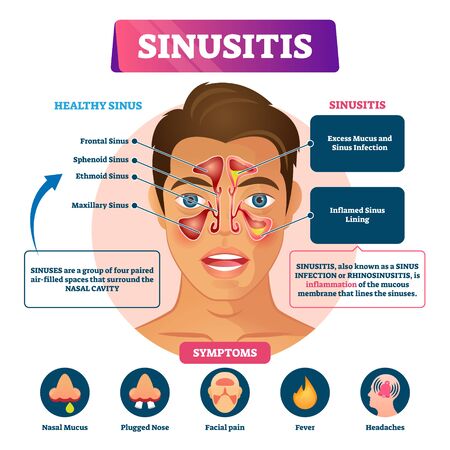 Vector of Sinusitis vector illustration. - ID:1-131892325 - Royalty Free Image - Stocklib