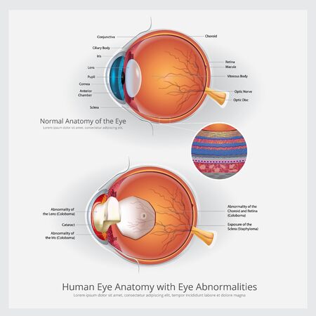 Eye Anatomy with Eye Abnormalities Vector Illustrationの素材 ...