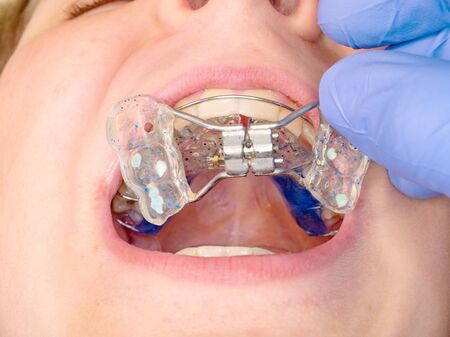 Palatal expander for the maxilla. The removable orthodontic appliance ...