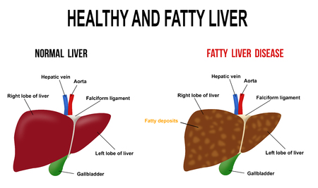 Healthy and fatty liver, vector illustration (for basic medical ...