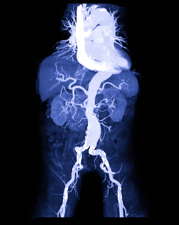 Photo of CTA abdominal aorta or CT - ID:1-127477730 - Royalty Free ...