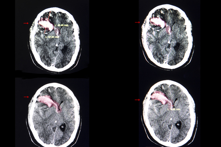 Photo of CT scan of the brain of a - ID:1-113899222 - Royalty Free ...