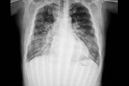 Photo of A chest x-ray of a patient - ID:1-123966857 - Royalty Free ...