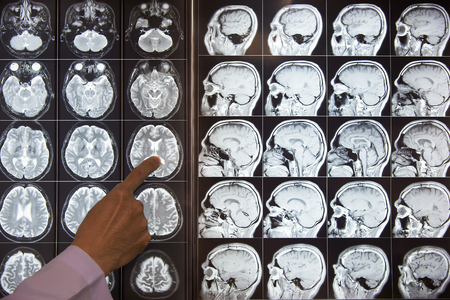 Doctor pointing at MRI of human brain on the light box to demonstrate ...