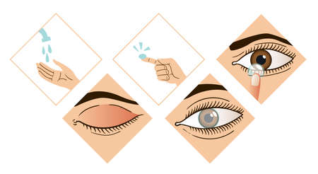 Vector of Contact lens infographic. - ID:1-163022911 - Royalty Free ...