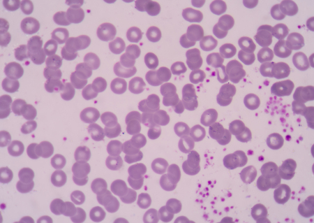 Photo of platelet clumping. - ID:1-47187764 - Royalty Free Image - Stocklib