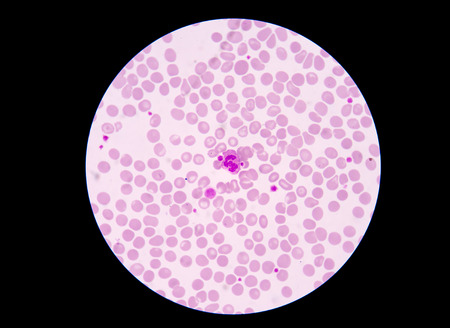 Photo of Giant platelet disorders are - ID:1-49788951 - Royalty Free ...