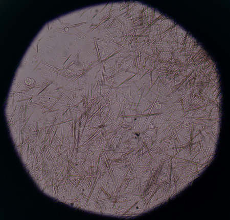 Moderate Uric acid crystal needle shape in synovial fluid find with ...