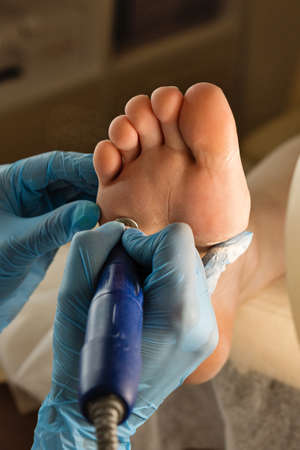 Podiatrist using grinding equipment and making procedure polish for ...
