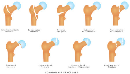 Vector of Hip fractures. Fractures of - ID:1-151404965 - Royalty Free ...
