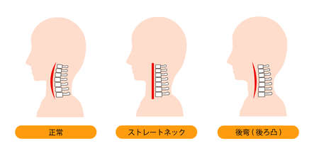 Vector of Straight neck, cervical - ID:1-170607640 - Royalty Free Image ...
