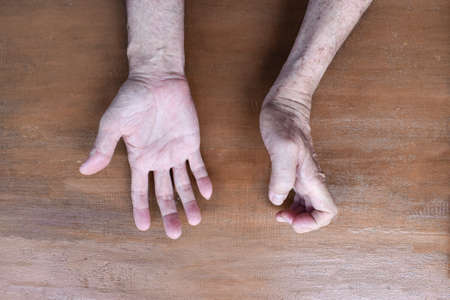 Photo of Volkmann contracture in left - ID:1-187415065 - Royalty Free ...