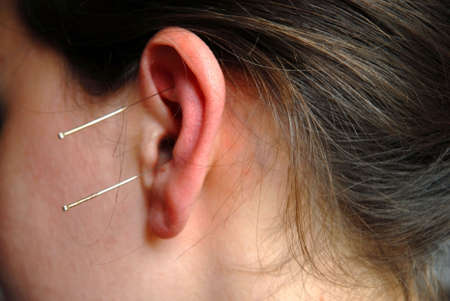 needles applicated in the ear for treatment of the patient - Stock ...